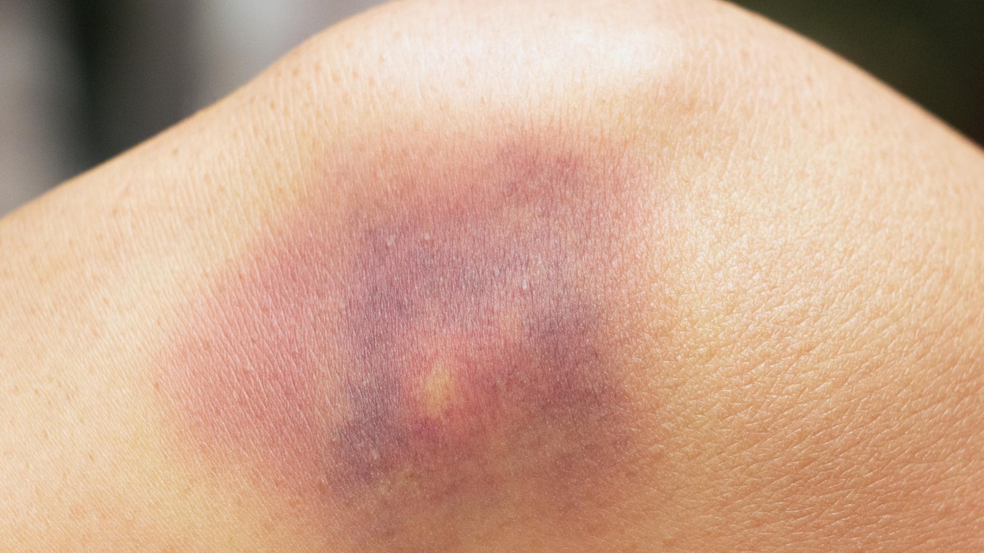 Bruises: Why are women more likely to get them than men?