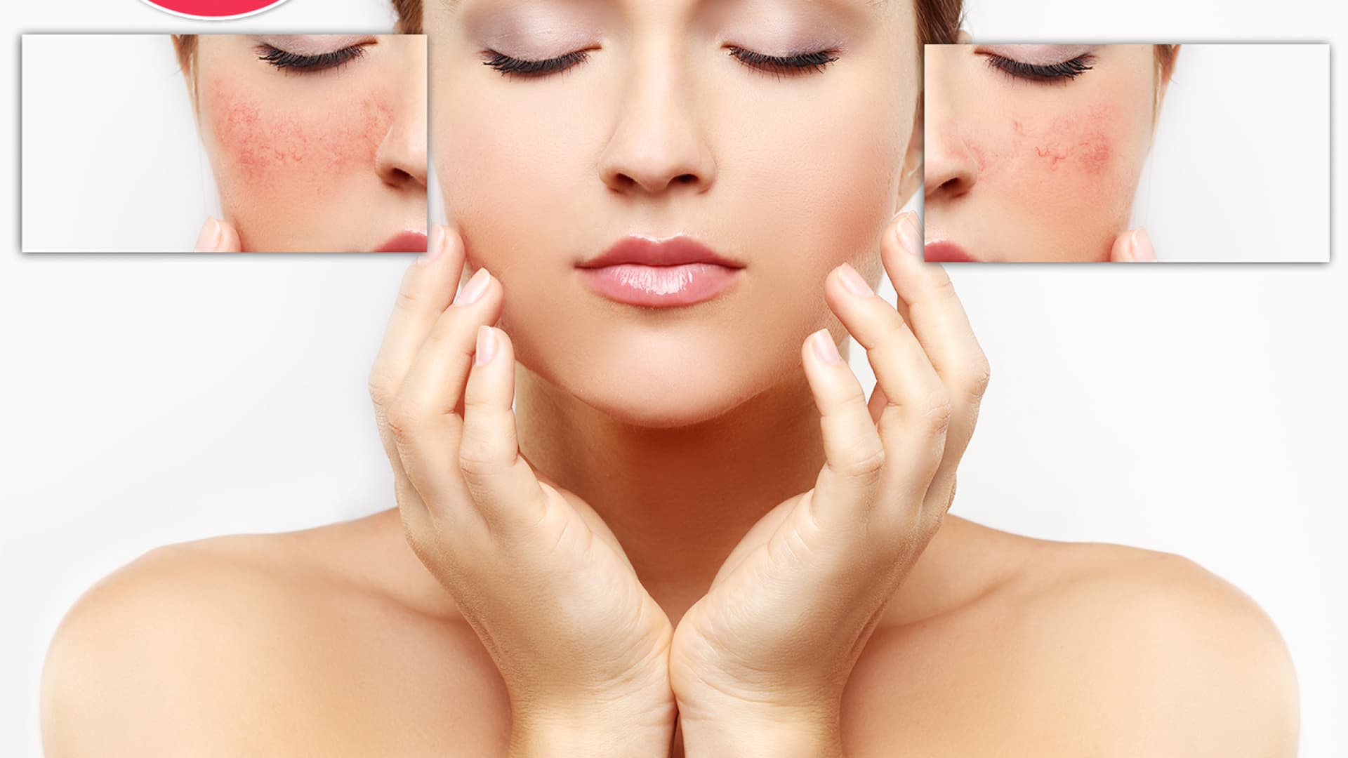 4 conseils de soins pour la rosacée